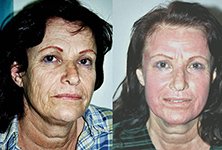 Exoderm peel - Exoderm I.M.C