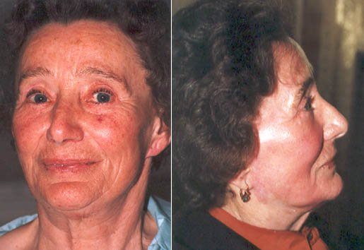 Exoderm Peel + Lift sin cirugía Exoderm International Medical Centers